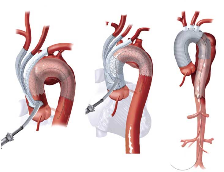 Aortic Surgery and Endovascular Stent Graft Application | Op. Dr. Murat ...